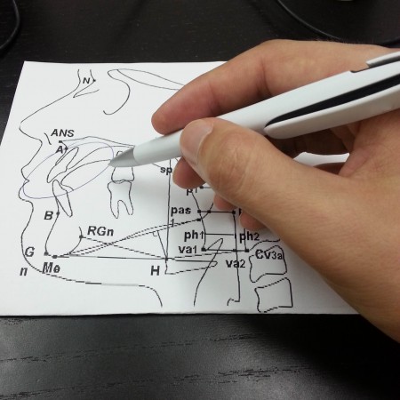 Ricketts Cephalometric Analysis - Cephx