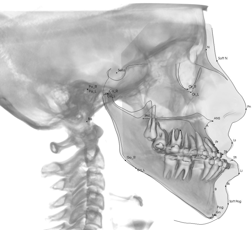 Comparison Between 2D and 3d cephalometric analyses | CephX