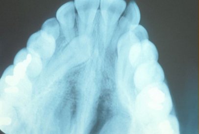 The Importance of Precise 3D Localization of Impacted Teeth Using CBCT ...