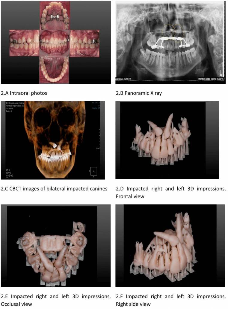 Diagnosis and Treatment plan of Maxillary Impacted canines using CBCT ...