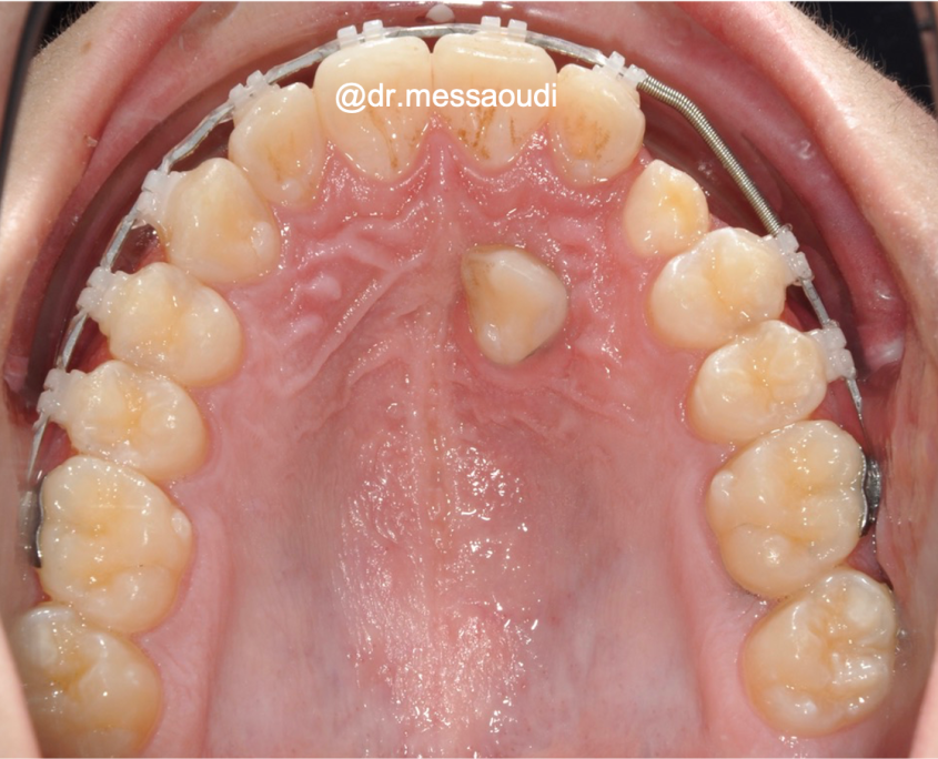 Case of impacted Canines created with Cephx AI algorithms - CephX | AI ...